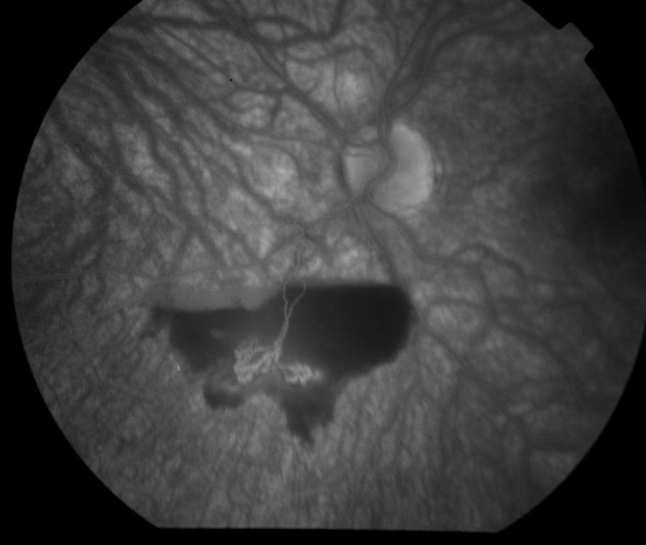Subhyaloid Hemorrhage | OphEd